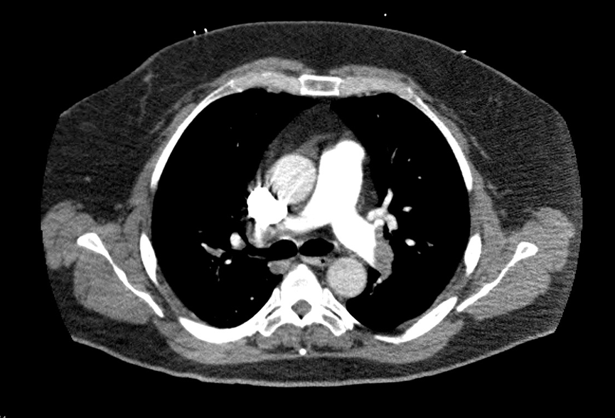 Optimal Treatment of Submassive Pulmonary Embolism - American College ...
