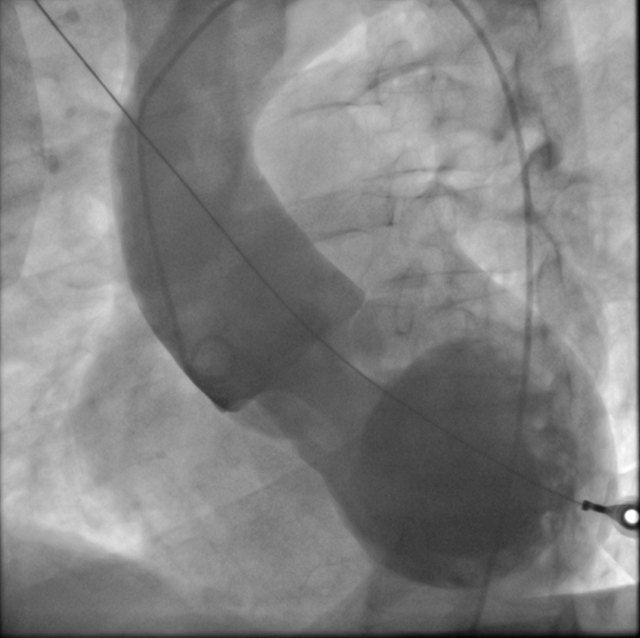 Aortography in Acute Aortic Dissection: An Undervalued Gold Standard ...