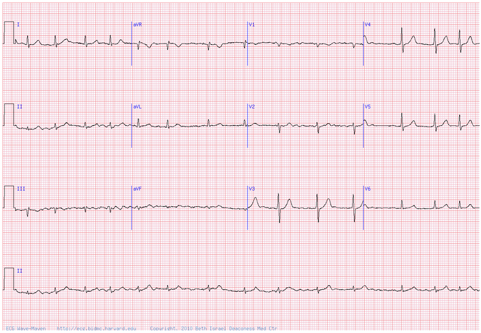 Strategy for Management of AFib Once OSA is Discovered - American ...