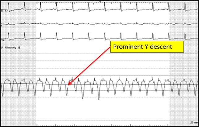 Constrictive Pericarditis Following Heart Transplant - American College ...