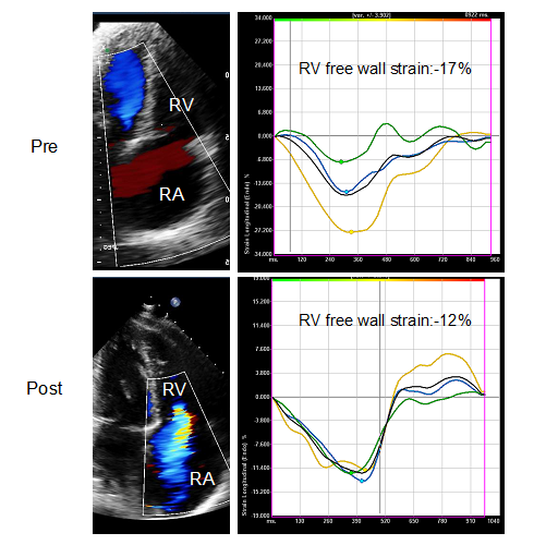 Constrictive Pericarditis: Pericardiectomy Didn't Fix the Problem ...