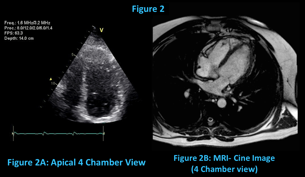 A Case of Pericarditis: Should We Treat Medically or Surgically ...