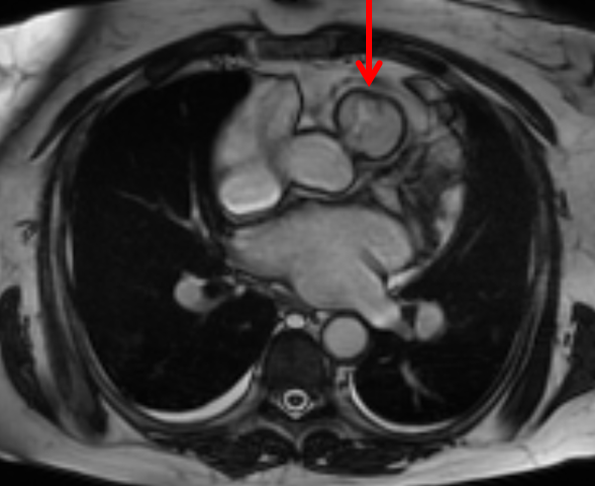A Case of a Not-So-Benign Murmur - American College of Cardiology