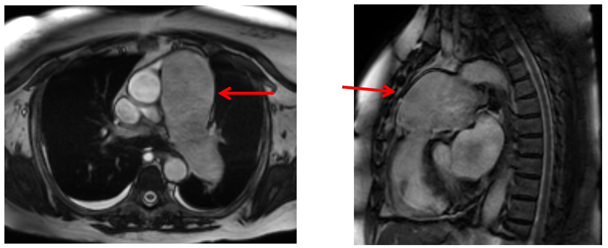 A Case of a Not-So-Benign Murmur - American College of Cardiology