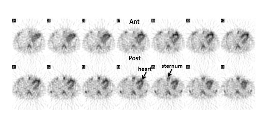 Technetium-99m Pyrophosphate SPECT for TTR Amyloid - American College ...
