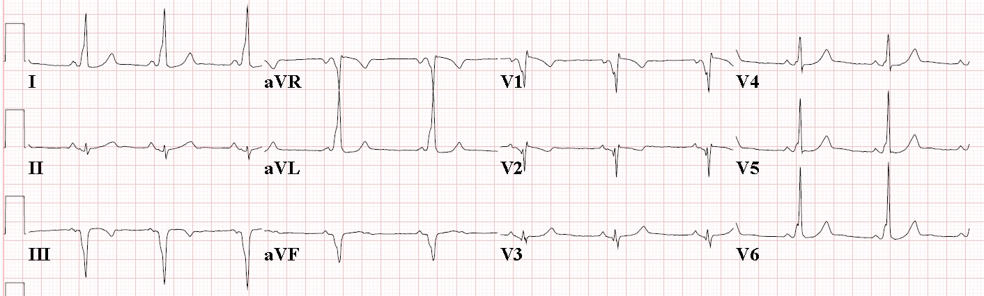 Anterior Myocardial Infarction Litfl Ecg Library