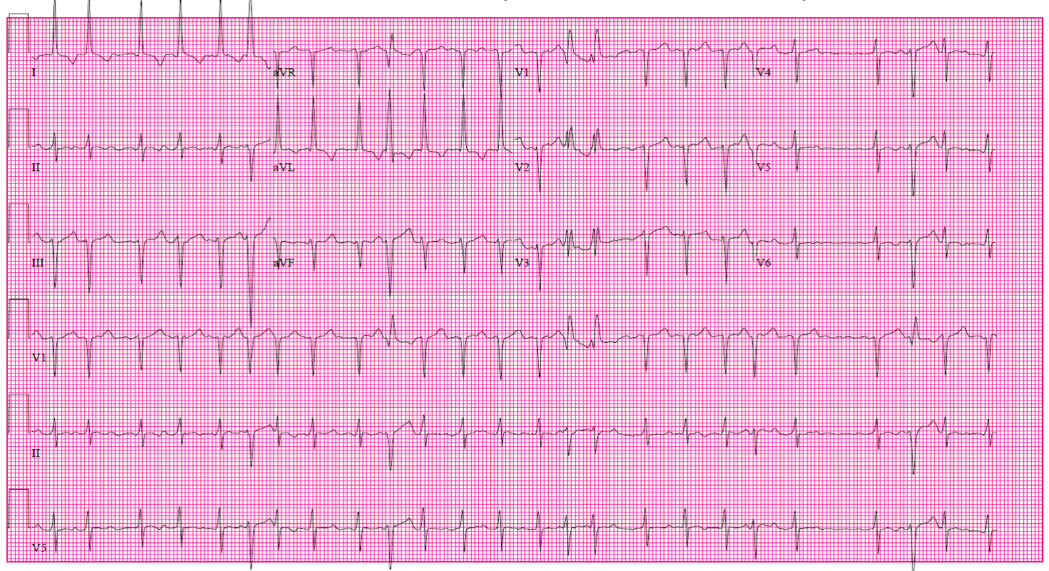 ECG of the Month: 48-Year-Old Man Presents with Fatigue, Dyspnea, and ...