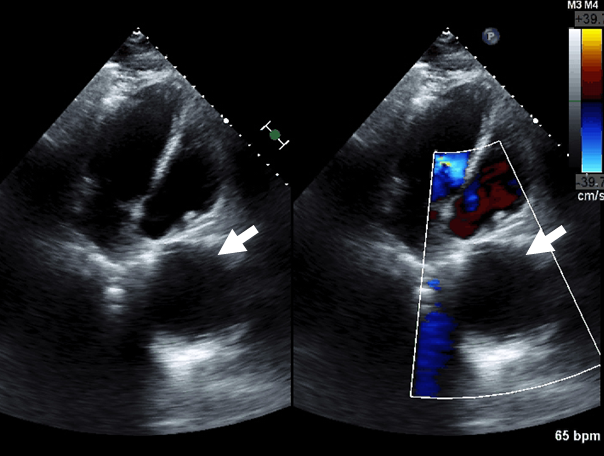 A Large Pericardial Mass - American College of Cardiology