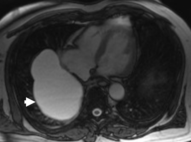 A Large Pericardial Mass - American College of Cardiology