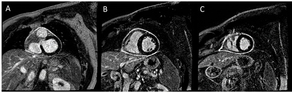 Recurrent Pericarditis: Stick to the Guidelines - American College of ...