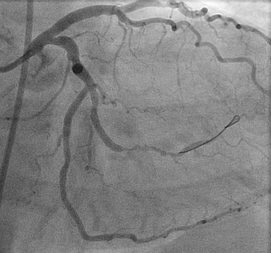 Edge Dissection Post Stent Deployment? - American College of Cardiology