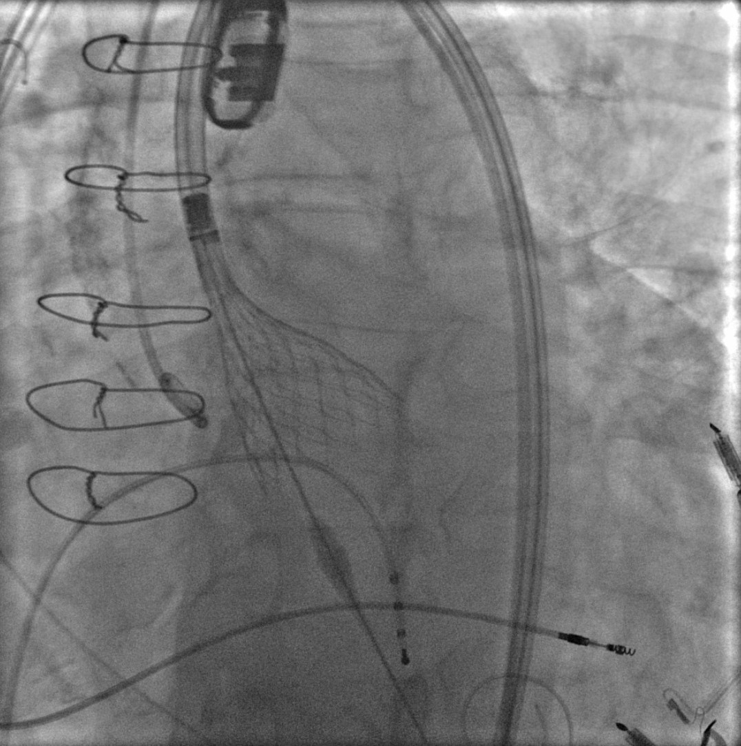 Valve-in-Valve TAVR in Aortic Homograft Failure - American College of ...
