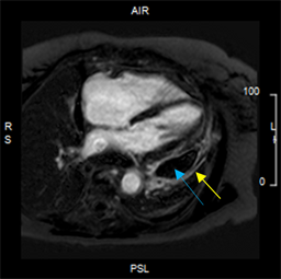 Pericardiectomy for Intractable Recurrent Pericarditis: When and Why ...