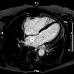 Pericardiectomy for Intractable Recurrent Pericarditis: When and Why ...