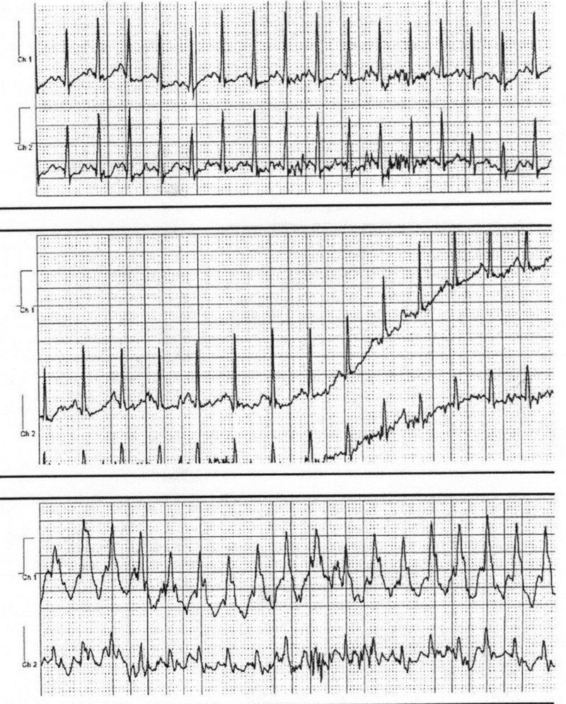 Young Patient with Palpitations on Exertion - American College of ...