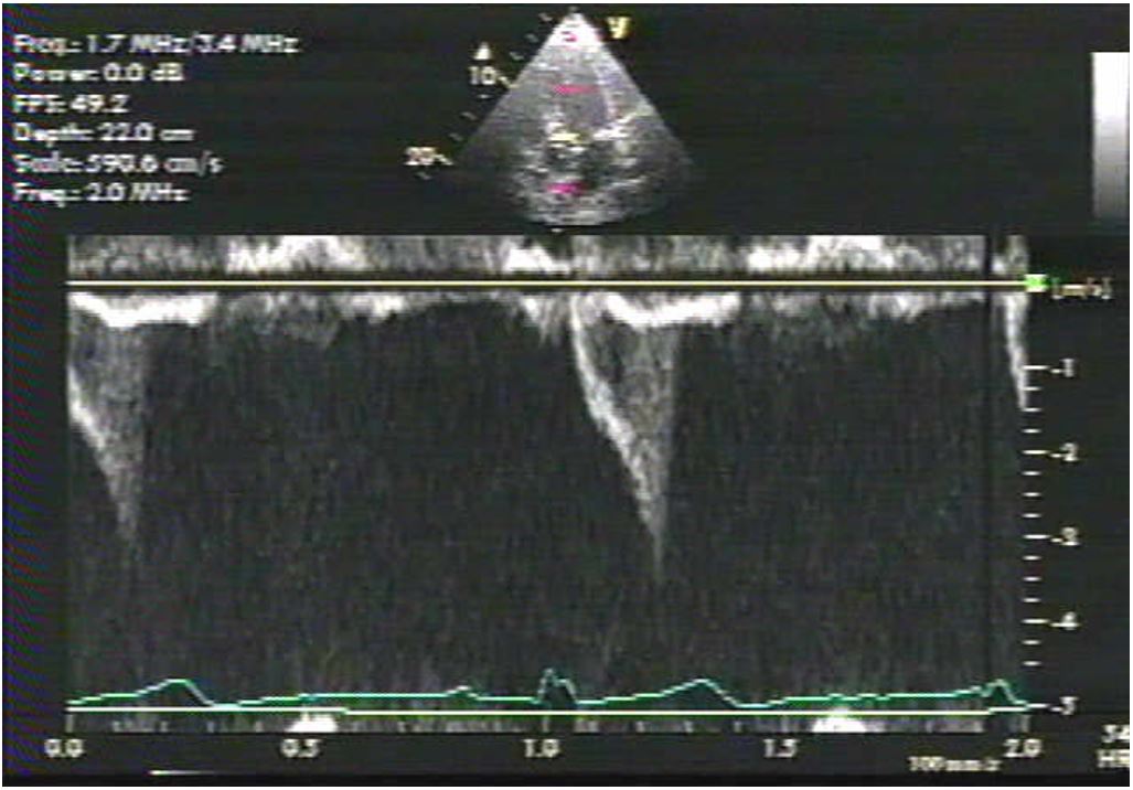 Mitral Regurgitation in HOCM - American College of Cardiology