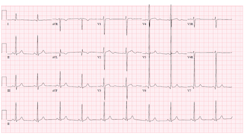 An Adolescent With a Murmur and an Unusual ECG - American College of ...