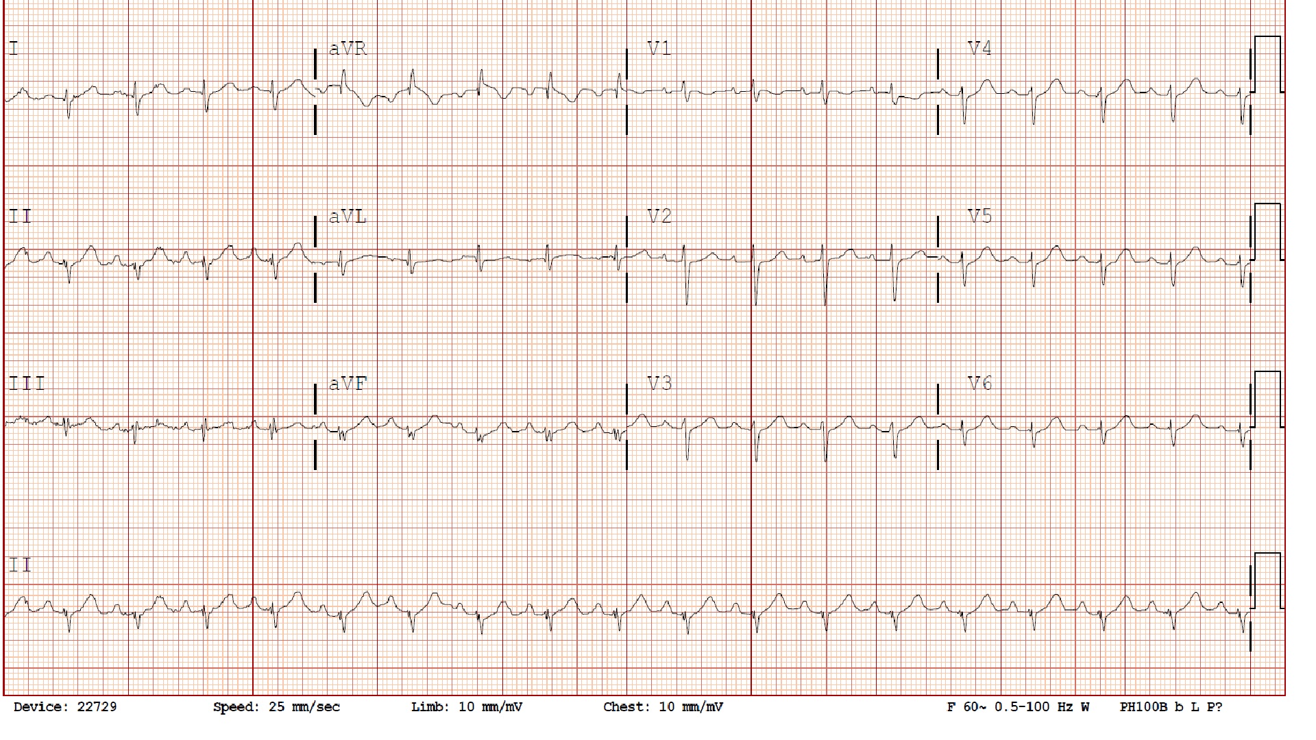 An Accidental Hole in the Heart - American College of Cardiology