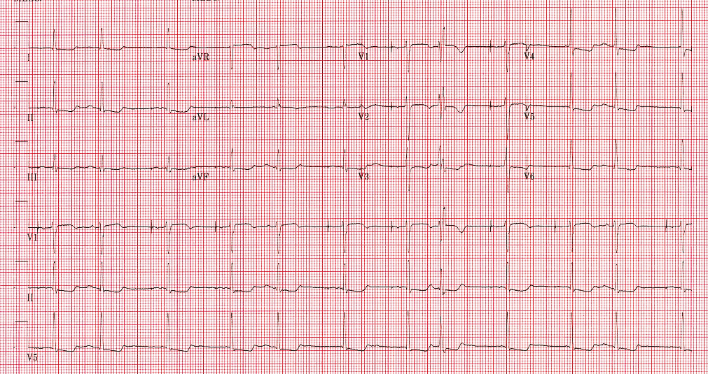ECG of the Month: Palpitations and Chest Pain - American College of ...