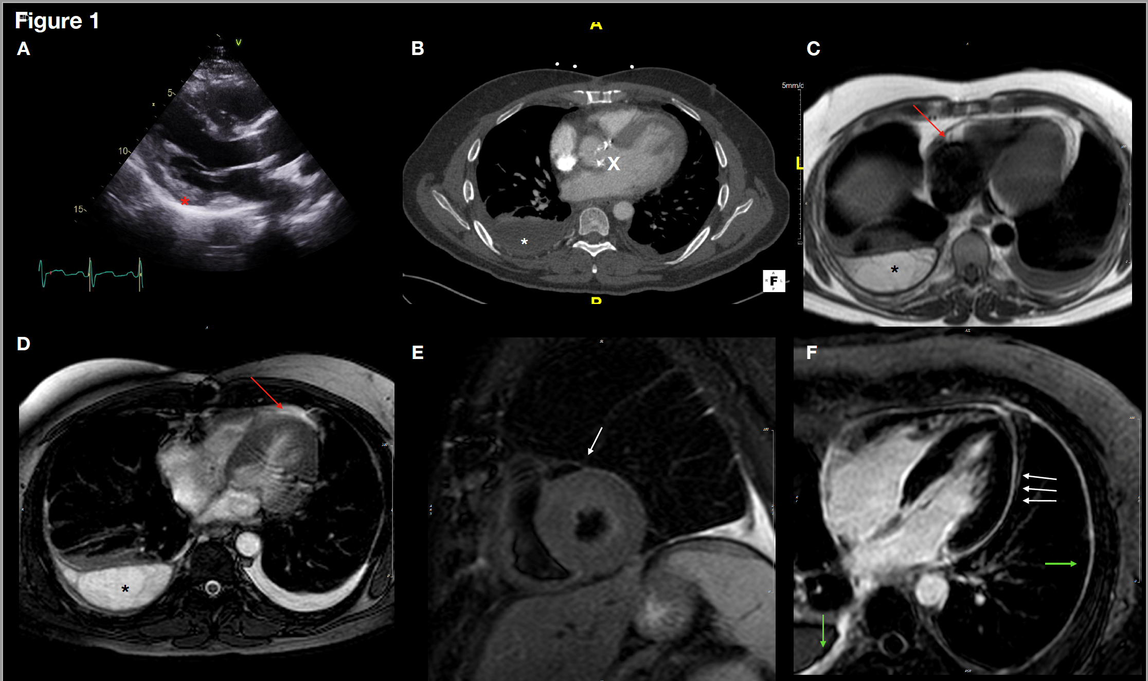 Persistent Chest Pain After Cardiac Surgery - American College of ...