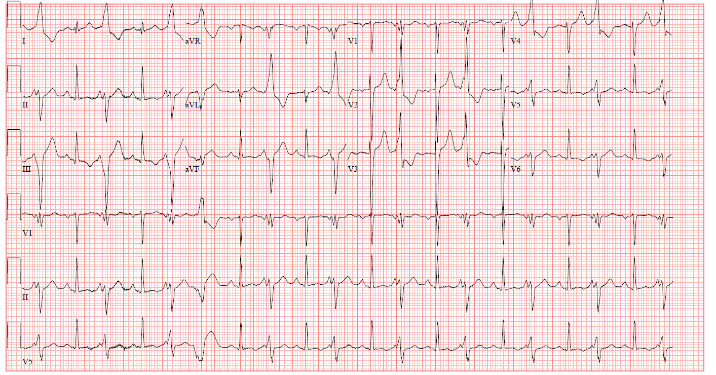 ECG of the Month: Variable QRS Morphologies in Heart Failure - American ...