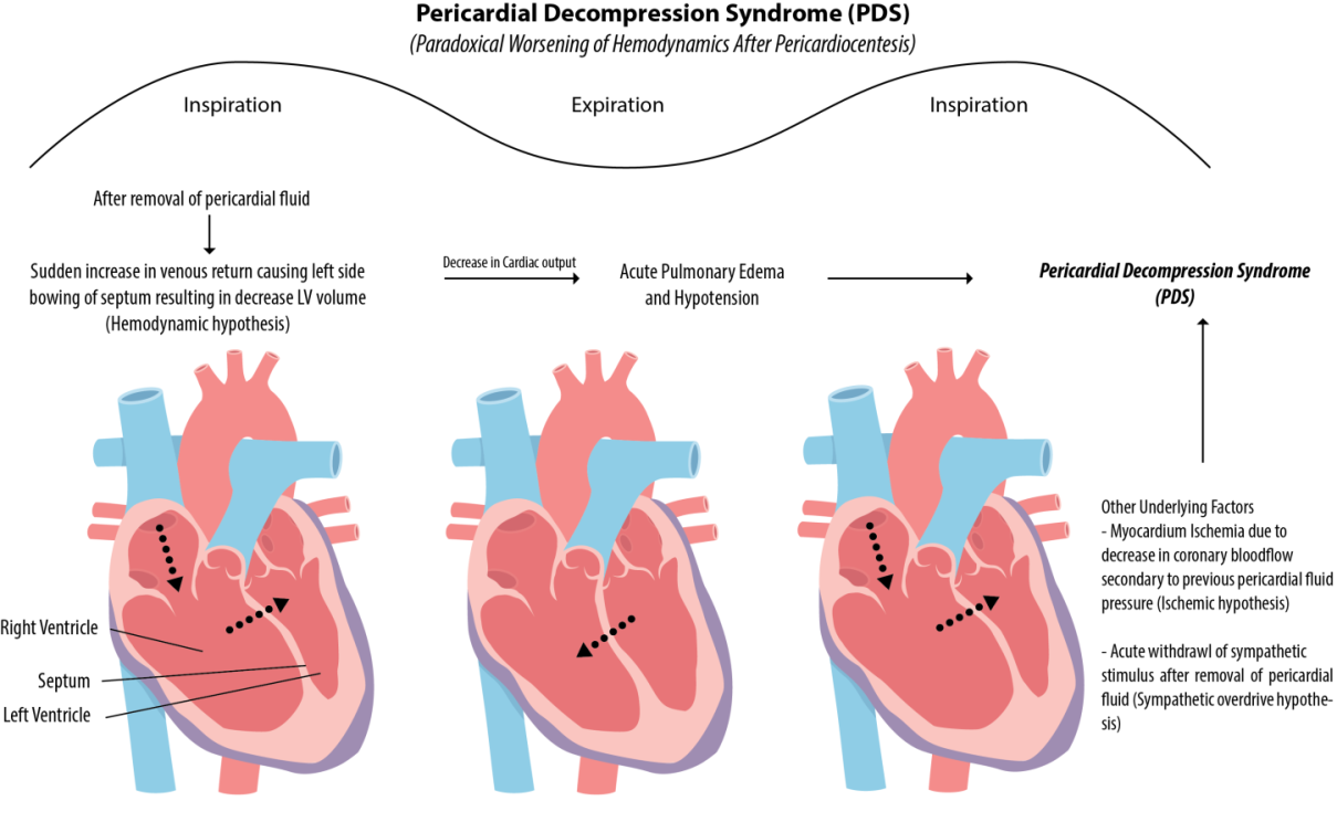 Pericardial Decompression Syndrome - American College of Cardiology
