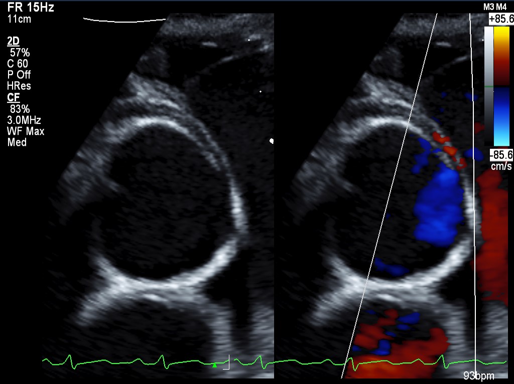 Sudden Cardiac Arrest and Anomalous Aortic Origin of a Coronary Artery ...
