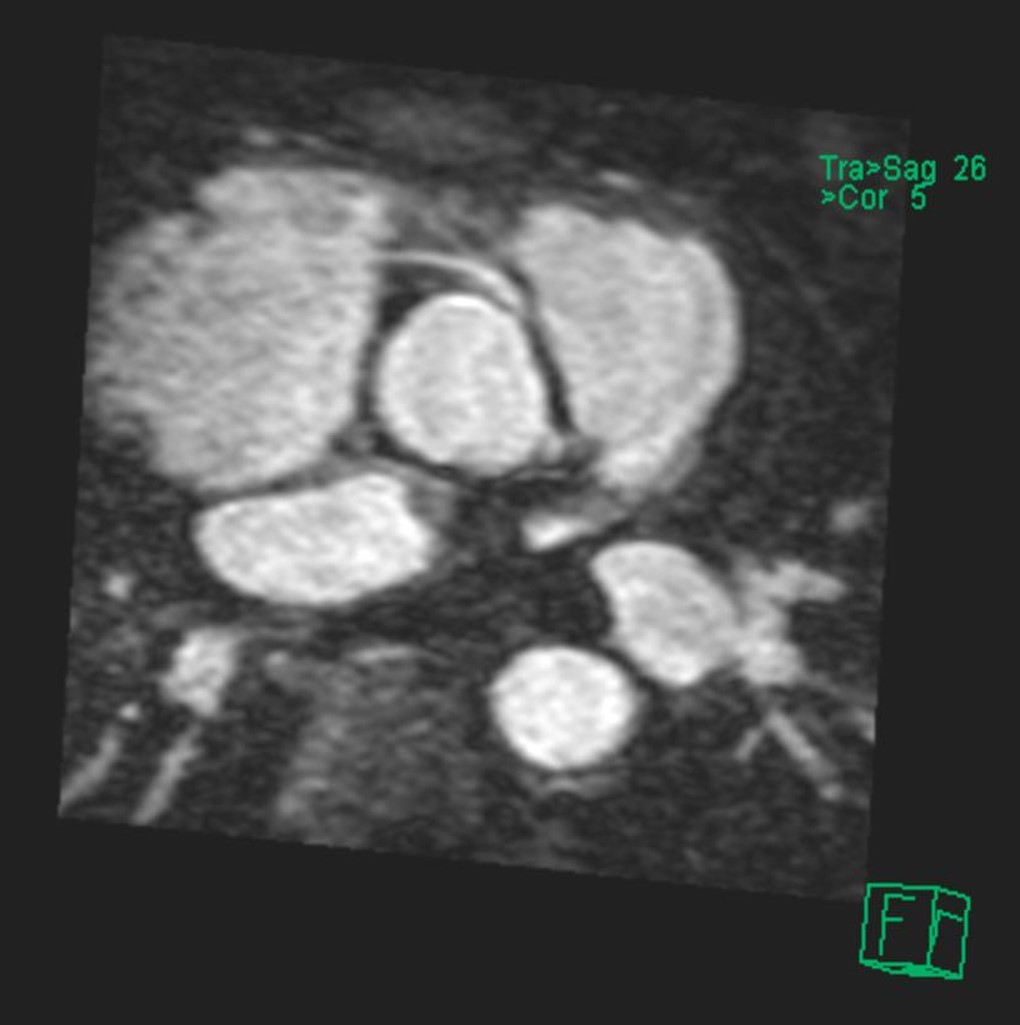 Sudden Cardiac Arrest and Anomalous Aortic Origin of a Coronary Artery ...