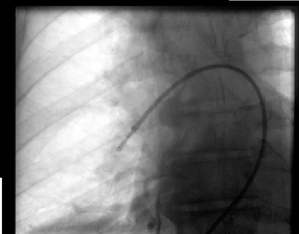 Perspective | Catheter-Directed Management in Acute Pulmonary Embolism ...