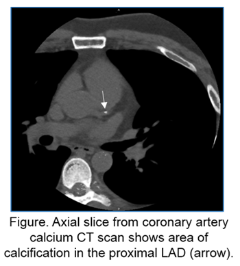 A Middle-Aged Woman With Hyperlipidemia, Subclinical Atherosclerosis ...