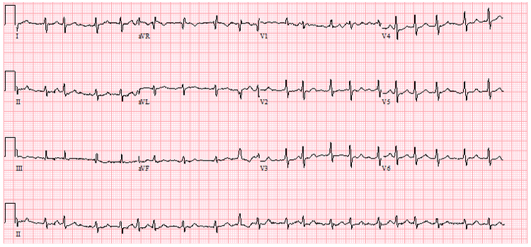 From Normal Sinus to Ventricular Tachycardia Arrest - The Sinister Role ...